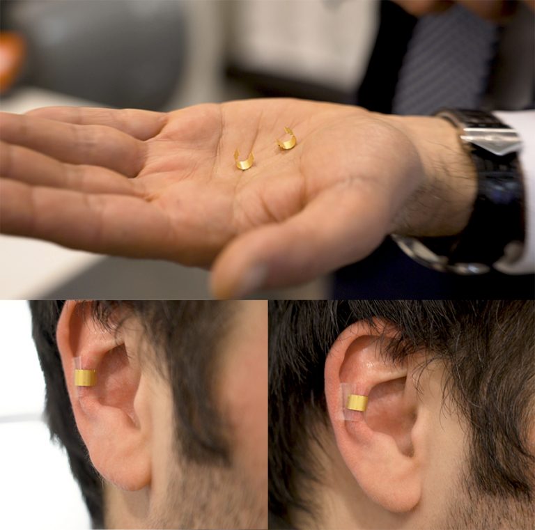 Earfold implant vs. traditional pinnaplasty: 5 reasons why the Earfold ...